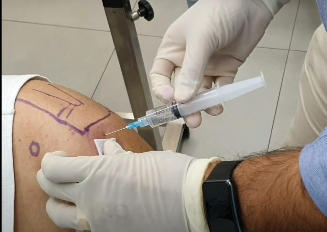 ROTATOR CUFF TENDINITIS AND TEAR - Pradeep Balasubramanian