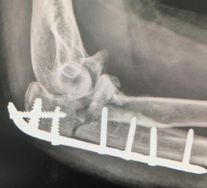 Elbow Fracture Treatment Abu Dhabi | Dr Pradeep Bala