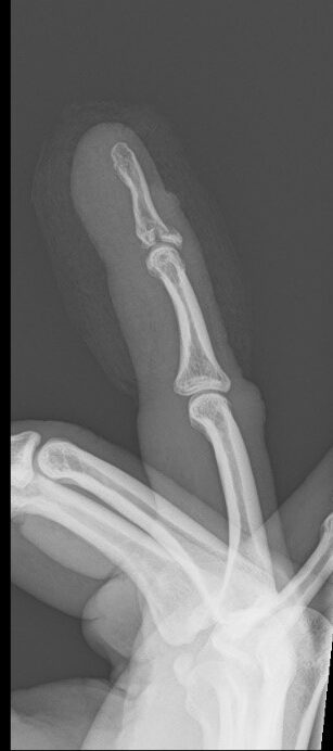 Mallet Finger Treatment Abu Dhabi, UAE