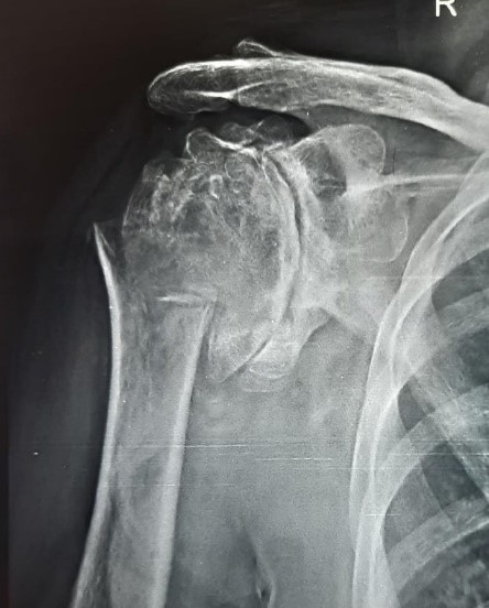 Arthritis Of The Shoulder treatment in Abu Dhabi