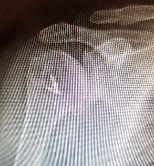 Arthritis Of The Shoulder treatment in Abu Dhabi