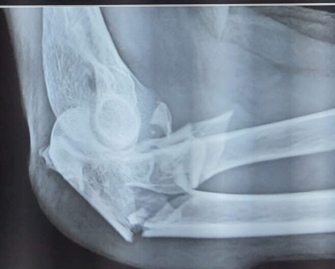 Elbow Fracture Treatment Abu Dhabi | Dr Pradeep Bala