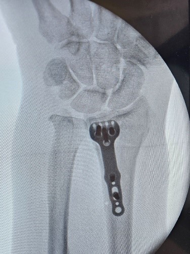 WRIST (DISTAL RADIUS) FRACTURE AND DISLOCATION - Pradeep Balasubramanian