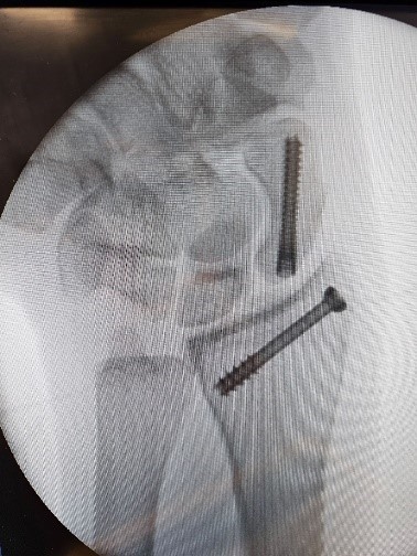 Wrist Fracture and Dislocation Treatment | Abu Dhabi, UAE