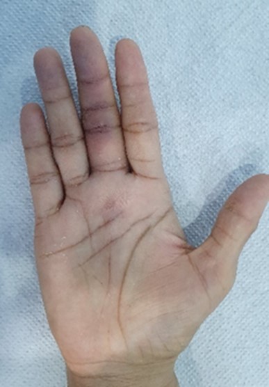 Hand Infections Treatment in Abu Dhabi – Expert Care