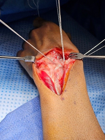 Wrist Sprain – Scapholunate Dissociation | Treatment in UAE